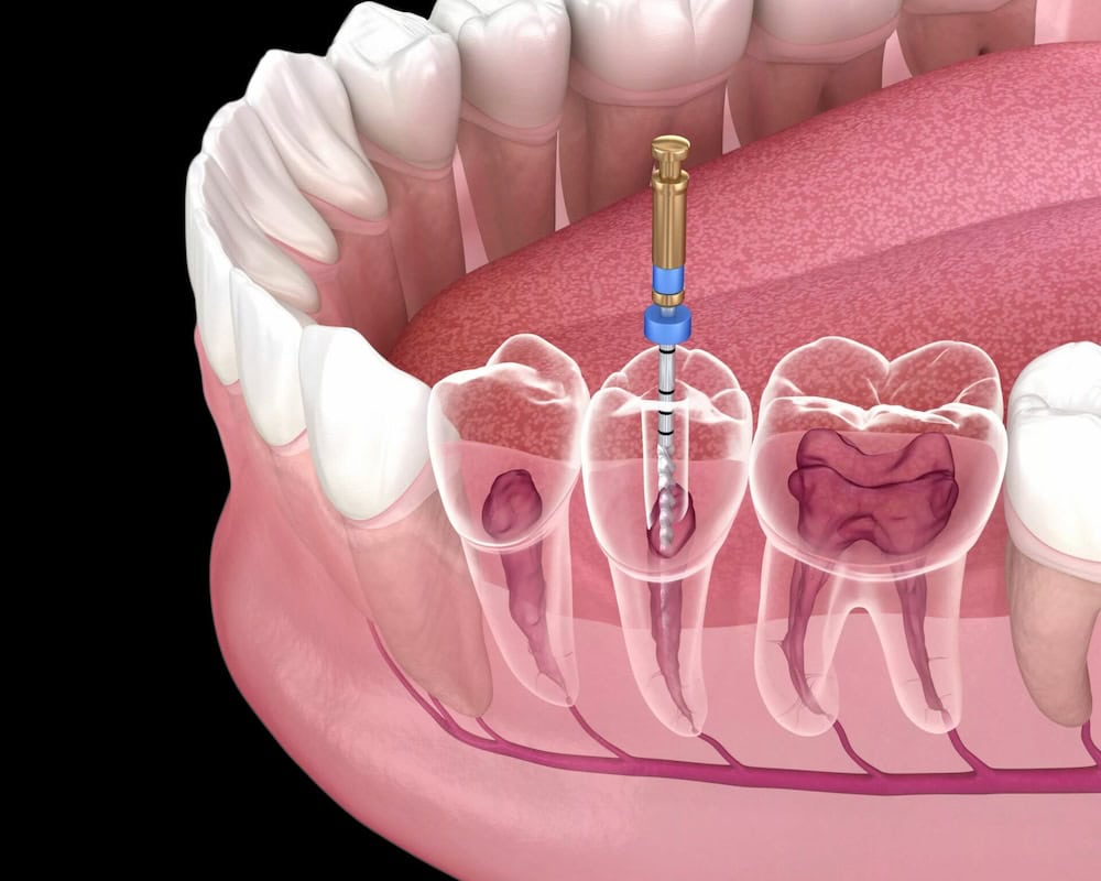 Endodontic Treatment | Granddent Dental Clinic